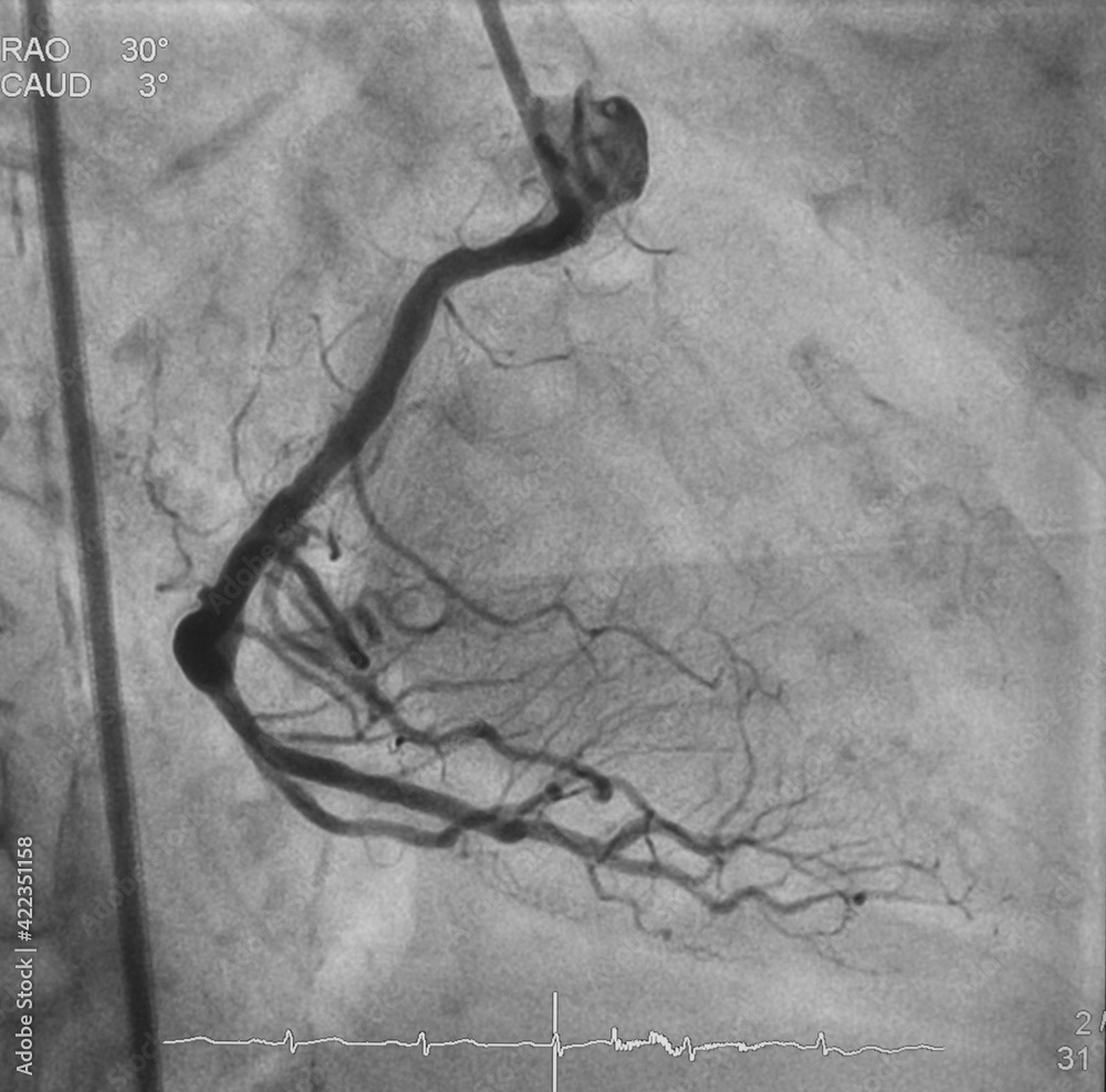 Coronary angiogram (CAG) was performed right coronary artery (RCA ...