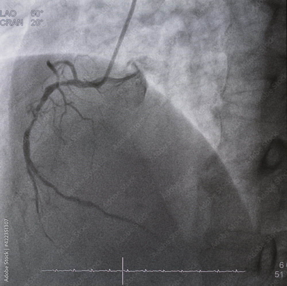 Coronary angiogram (CAG) was performed right coronary artery (RCA ...
