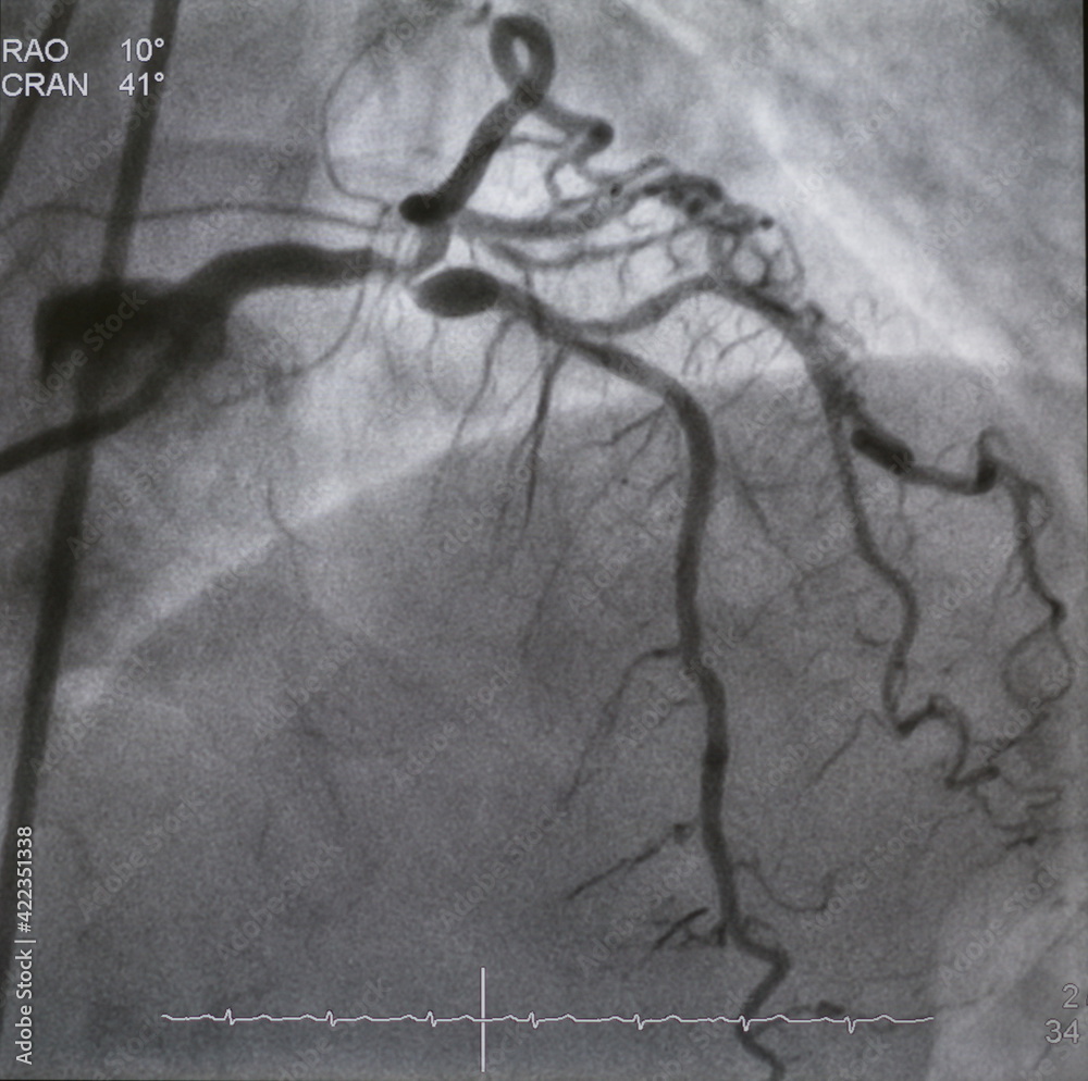 Coronary angiogram (CAG) was performed left coronary artery (LCA ...