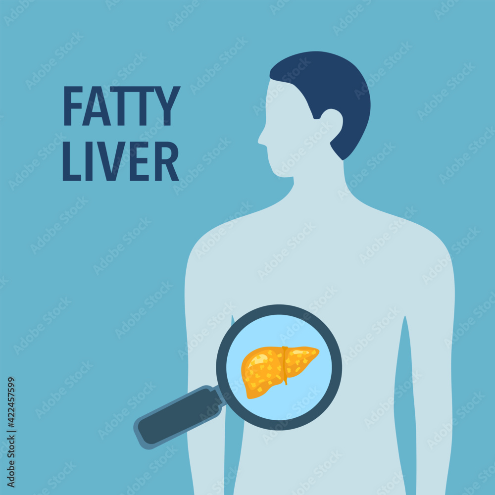 Fatty liver disease vector illustration. Human liver damage in flat ...