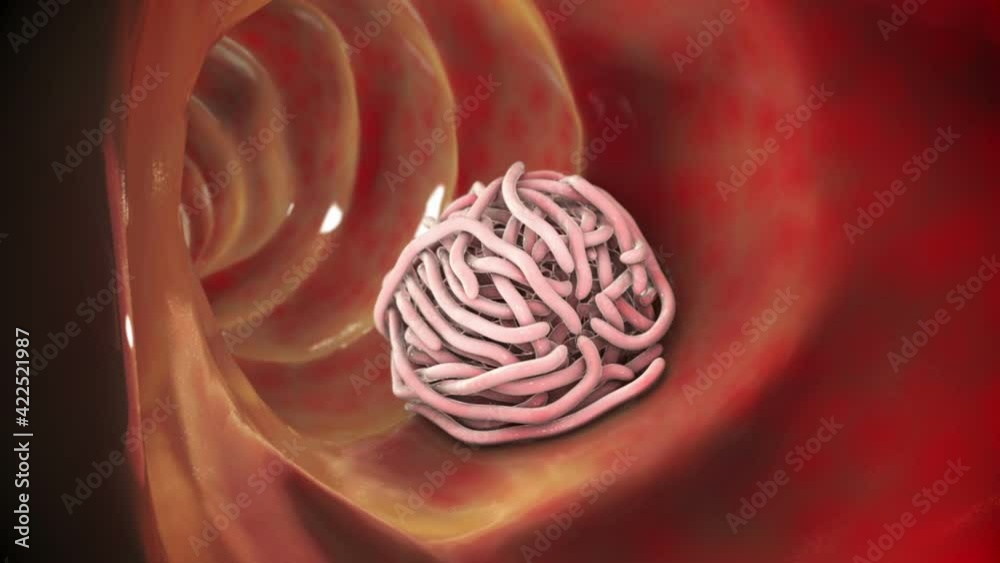 Stockvideon Parasitic worms in the intestinal lumen, 3D animation ...
