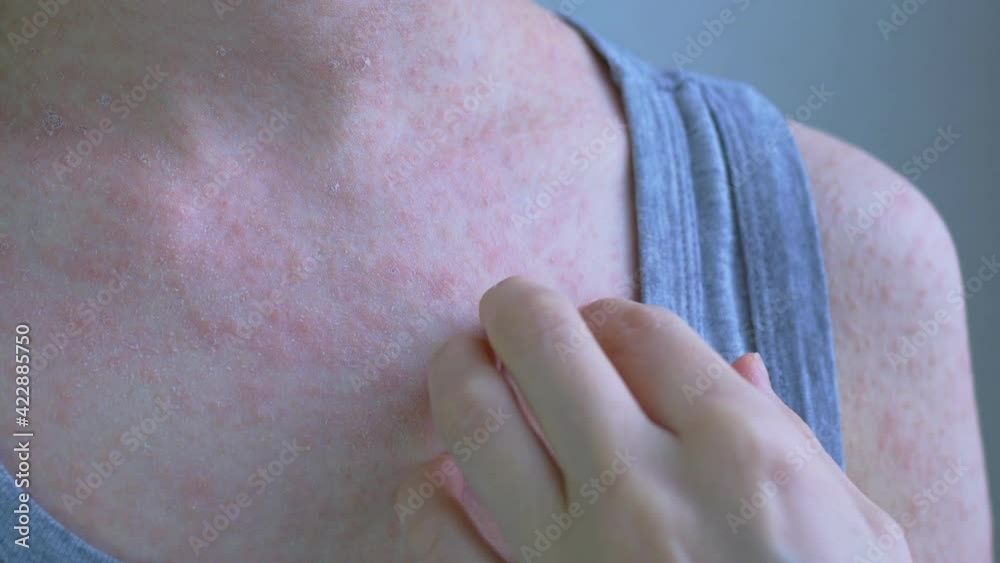 A close-up shot of a reddened rash in the form of round spots of ...