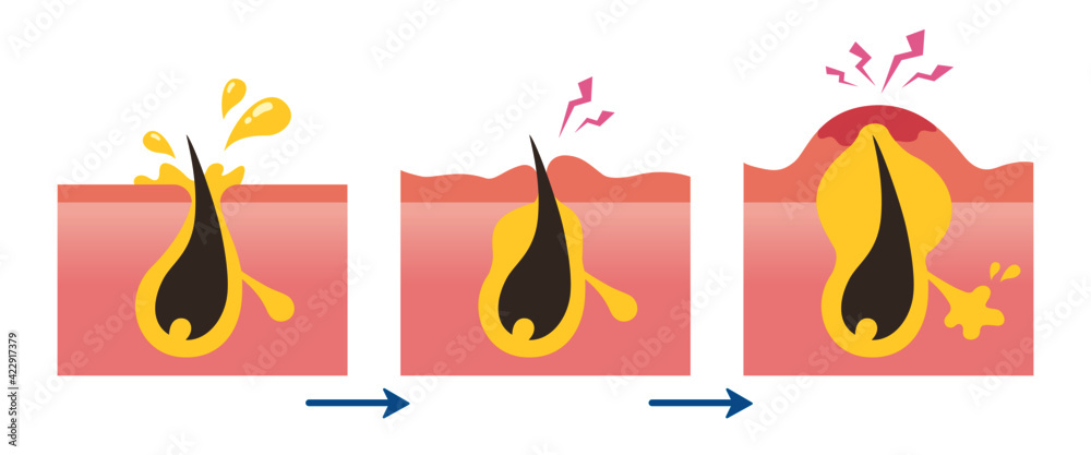 Formation of acne process. Oily pore, clogged with sebum, and pustules ...