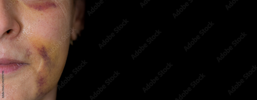 Woman face with bruises in the face, black background for text space ...
