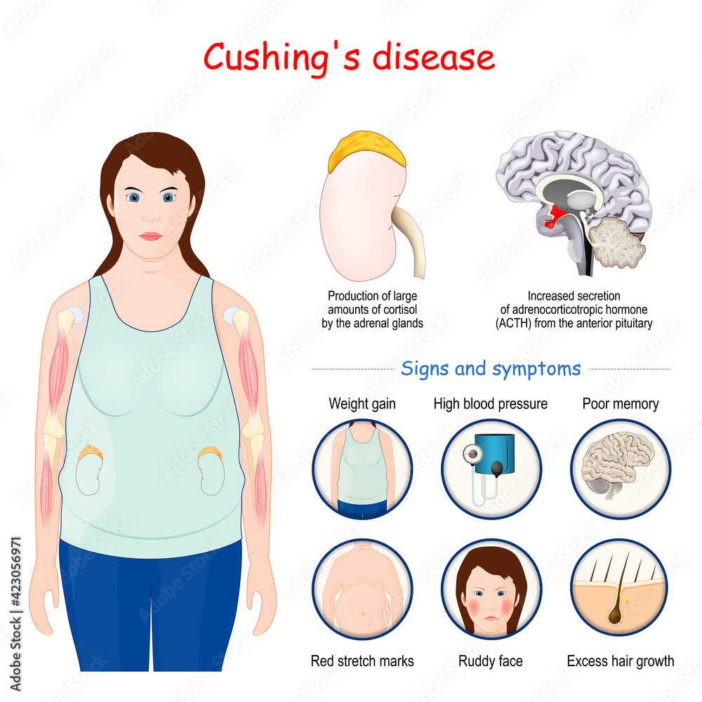 Cushing s Disease Signs And Symptoms Of Cushing Syndrome Stock Vector Cushing s Disease Signs And Symptoms Of Cushing Syndrome Stock Vector