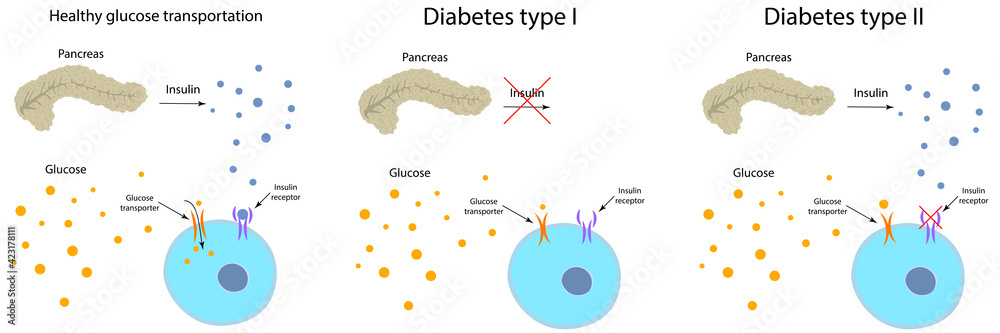 Diabetes type 2, 1, healthy transportation comparison. Pancreas ...