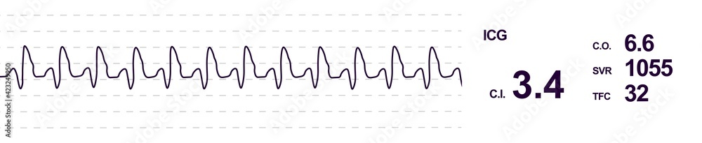 Impedance Cardiography(ICG) monitoring at the hospital. ICG monitor ...