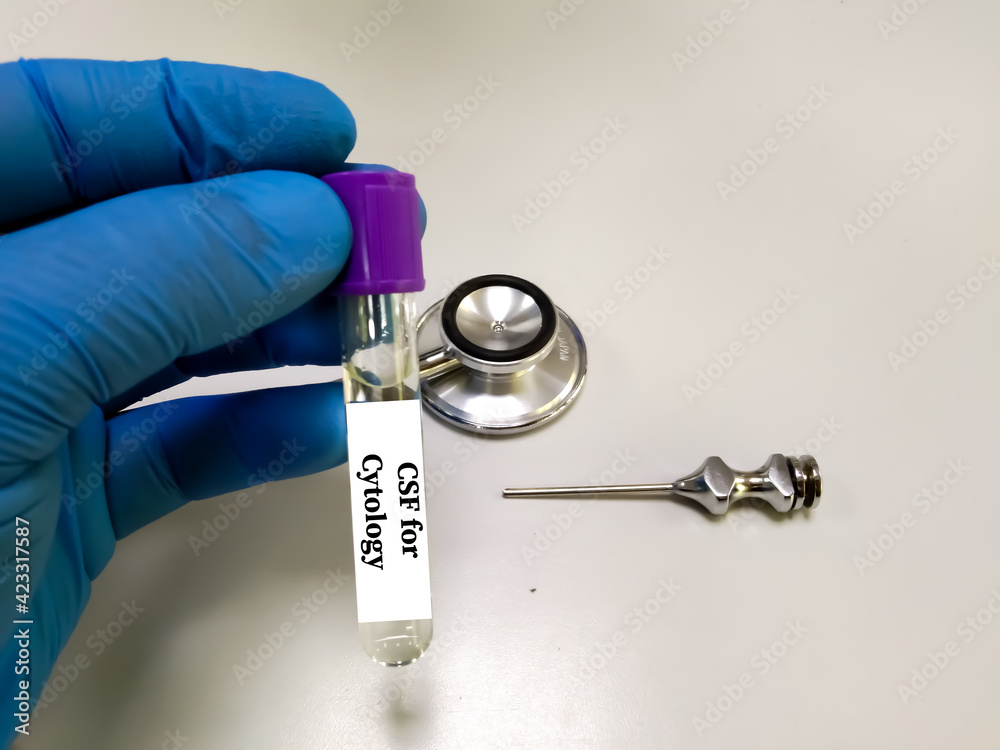 Biochemist hold Cerebrospinal fluid (CSF) sample with laboratory ...