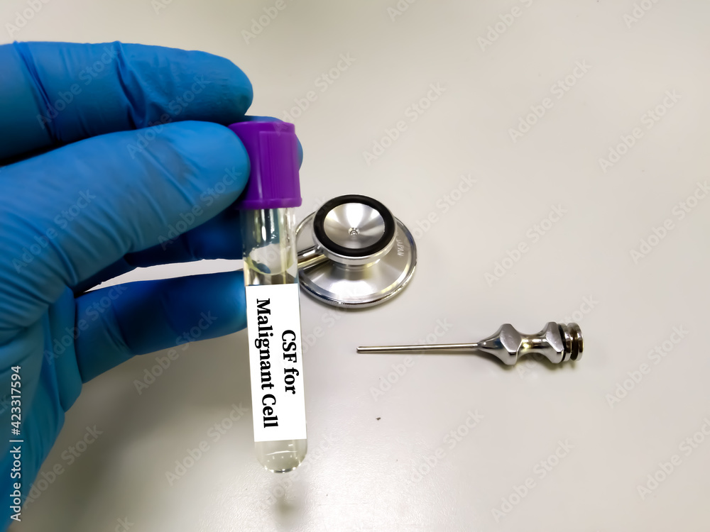 Biochemist hold Cerebrospinal fluid (CSF) sample with laboratory ...