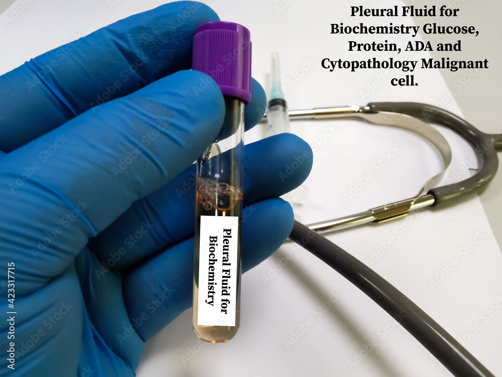 Pleural fluid sample with laboratory background, which is ready for ...