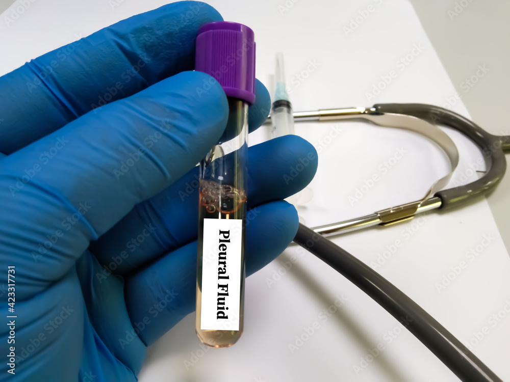 Pleural fluid sample with laboratory background, which is ready for ...