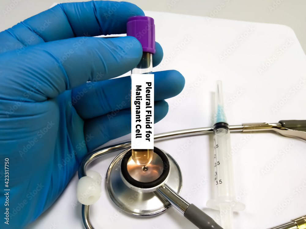 Pleural fluid sample with laboratory background, which is ready for ...