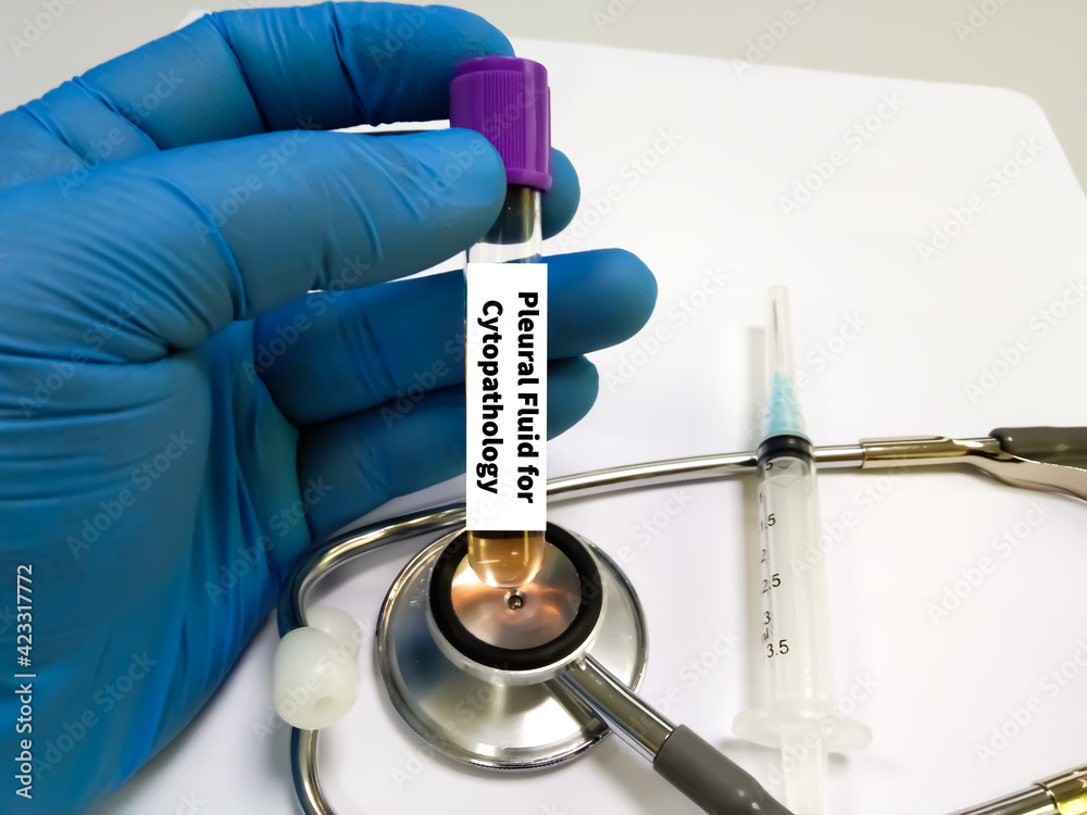 Pleural fluid sample with laboratory background, which is ready for ...