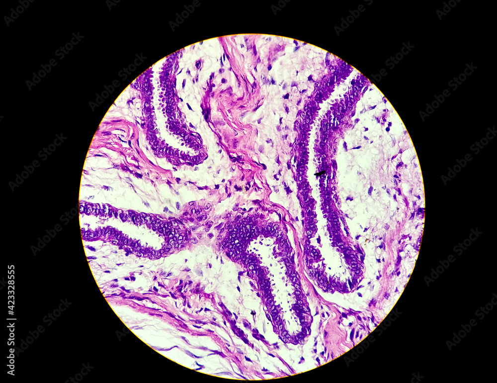 Breast tumor, or nephroblastoma, light micrograph, photo under ...