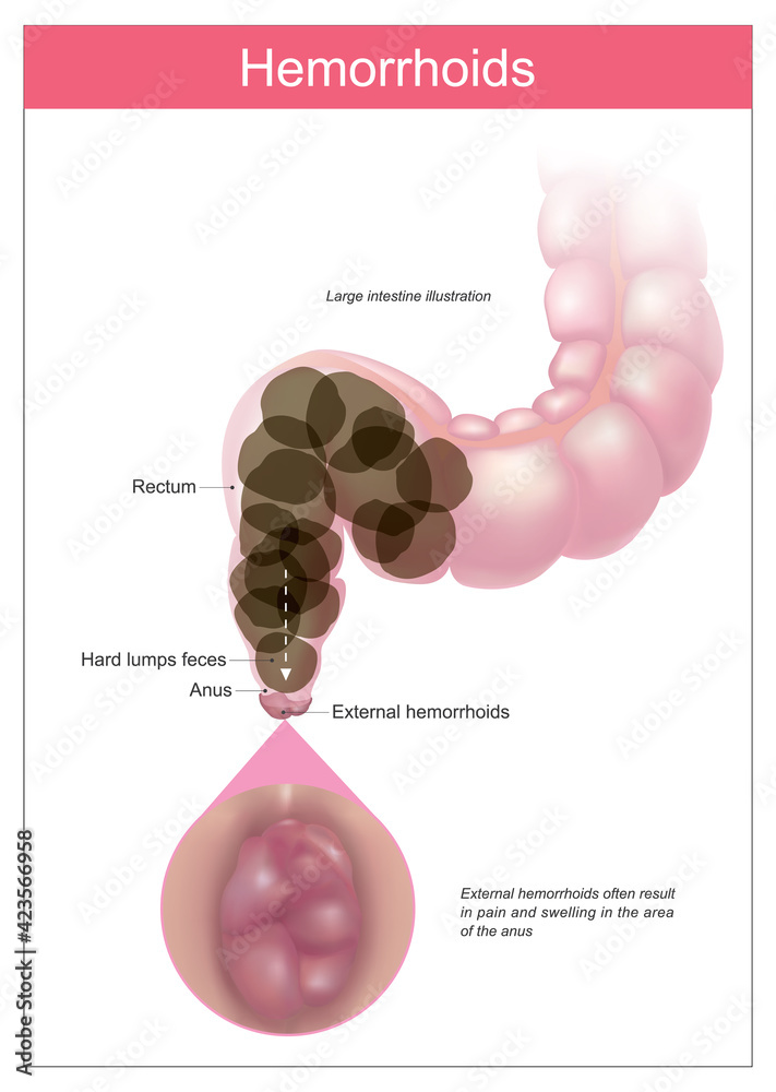 Hemorrhoids Illustration Explain Cause Of Haemorrhoids Your Anus