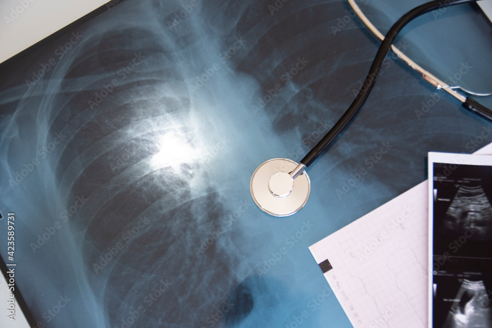 Covid 19 diagnosis with lung x-ray, doctor and stethoscope. Selected ...