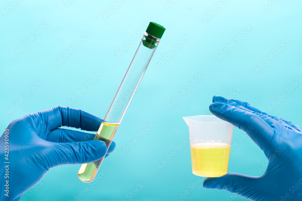 Urine analysis in the laboratory. Medical urine test. Urine sample for ...