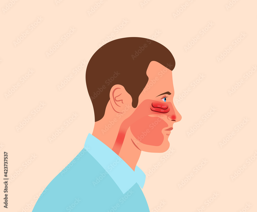 Man having rhinitis, allergy or nasal infection. Human head vector ...