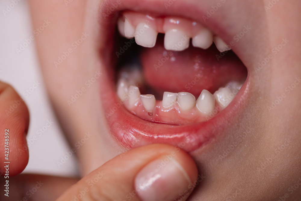 close-up the open mouth of a Caucasian child with the first baby tooth ...