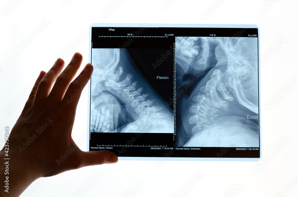 Fluorography. a snapshot of the x-ray of the cervical spine in four ...