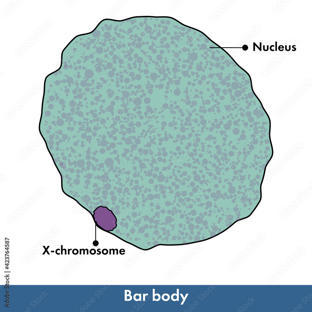 Bar body or x chromosome inactivation in Human female cell nucleus ...