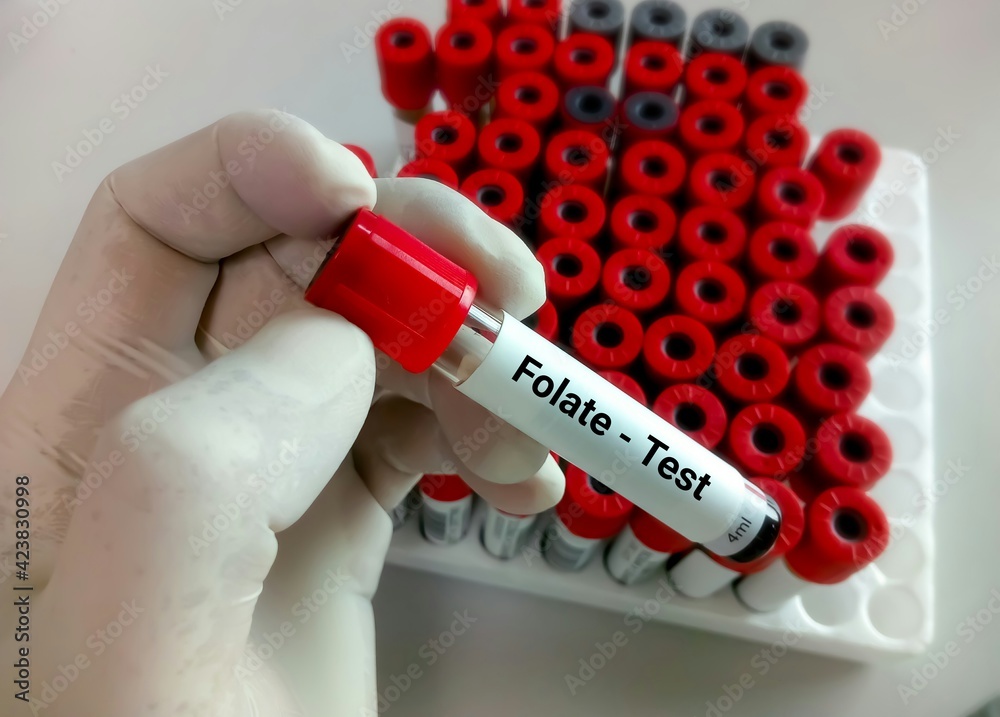 Scientist or biochemist hold blood sample for Folate test, iron ...