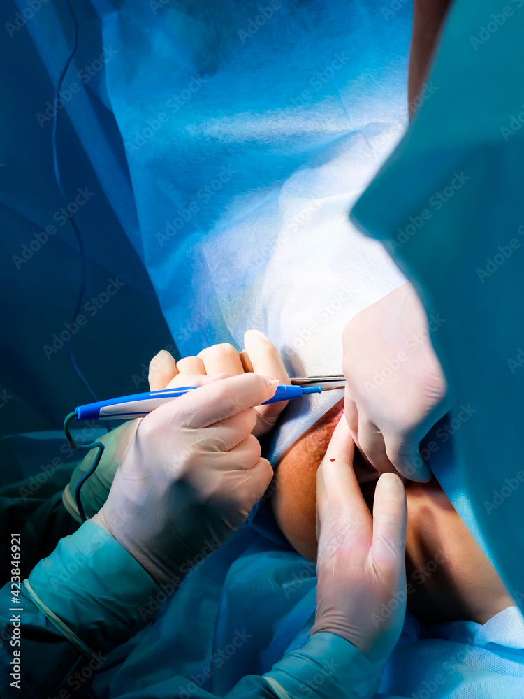 Selective focus on the hands of surgeons in sterile gloves working with ...