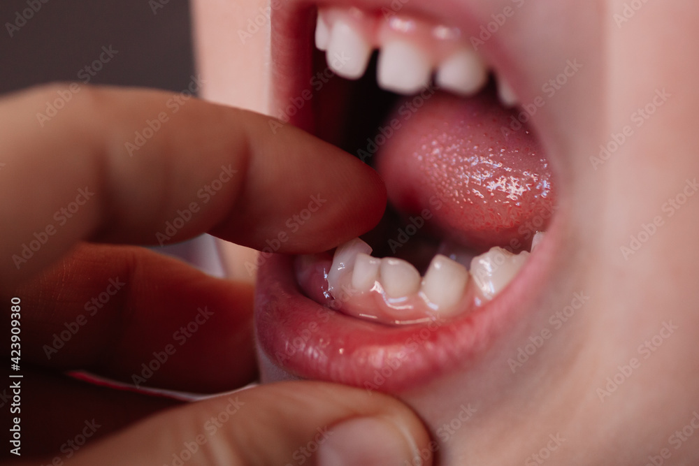 a close-up dentist examines the child's mouth and teeth and sees a ...