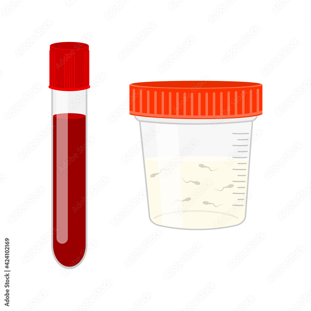 Male infertility tests. Blood and semen analysis. Blood in glass tube ...