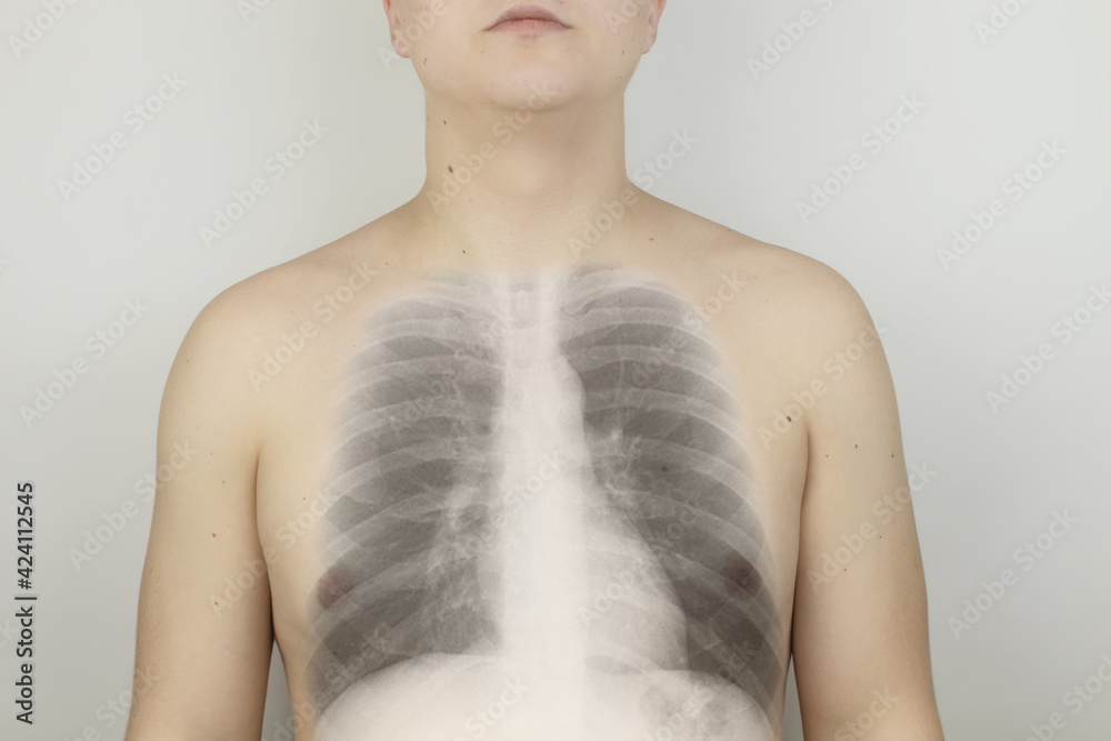 Conceptual photo. Male chest x-ray. An image of the ribs and lungs ...