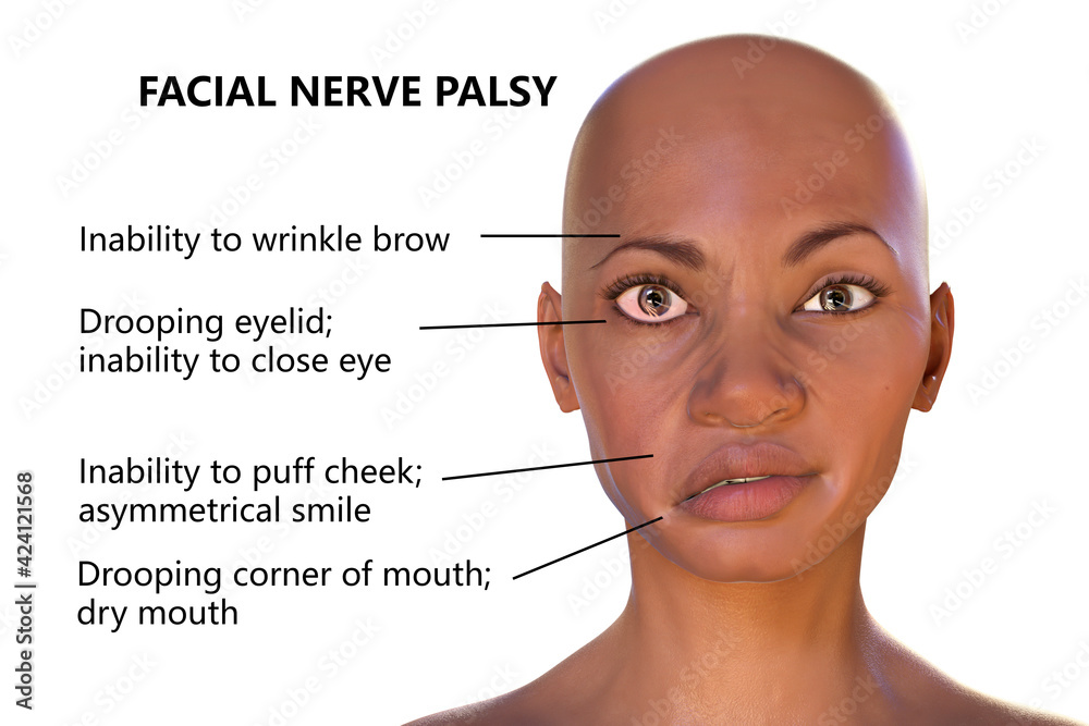 Facial nerve paralysis, Bell's palsy, illustration showing female with ...