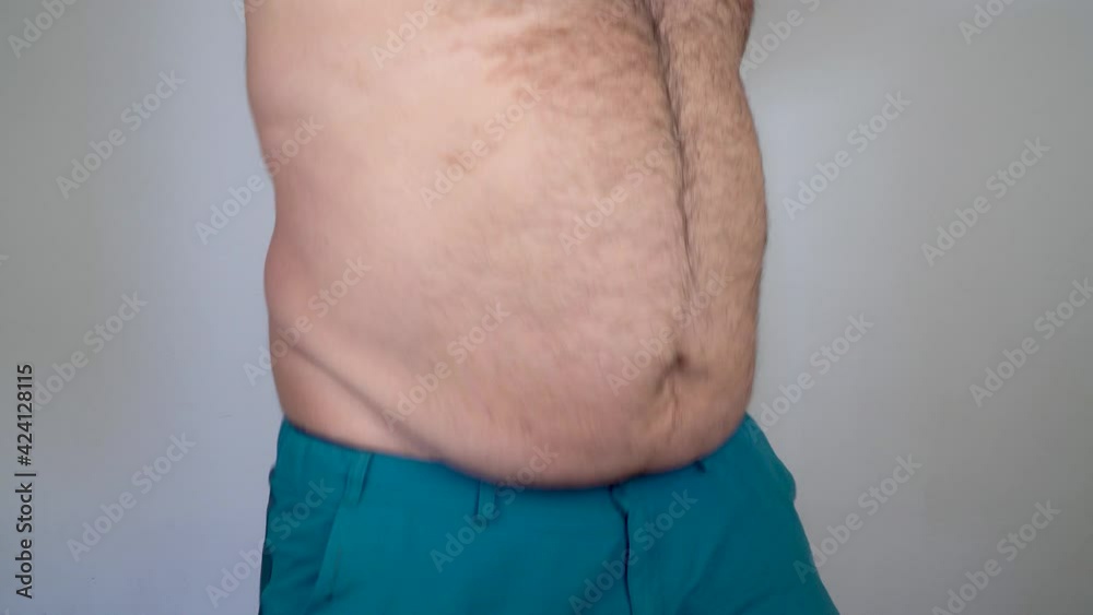 man shows his big belly and shakes his fat folds. problems of poor ...