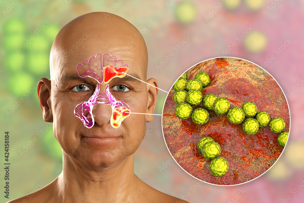 Inflammation of frontal, maxillary, and ethmoid sinuses and close-up ...