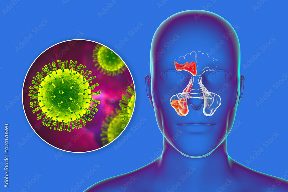 Viral sinusitis, inflammation of paranasal cavities and close-up view ...