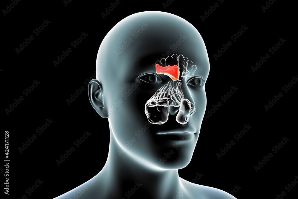 Sinusitis, inflammation of paranasal cavities. Illustration showing pus ...