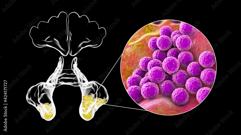 Purulent inflammation of maxillary sinuses and close-up view of ...