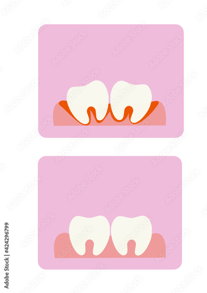 Vector illustration of teeth on a pink background. Bleeding ...