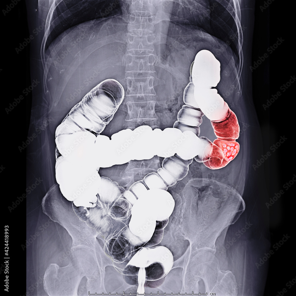 barium enema image or x-ray image of large intestine Prone position ...