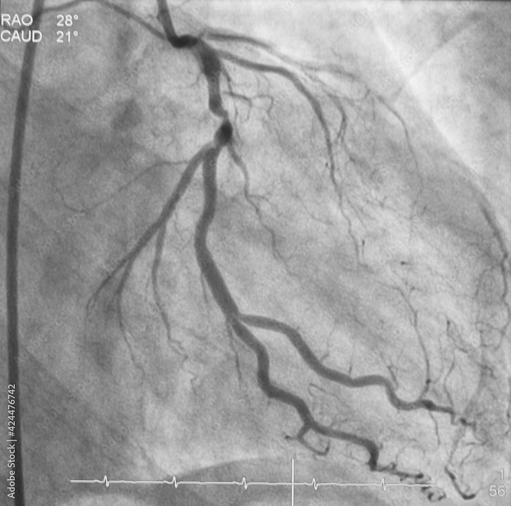Coronary angiogram (CAG) was performed left circumflex artery (LCx ...