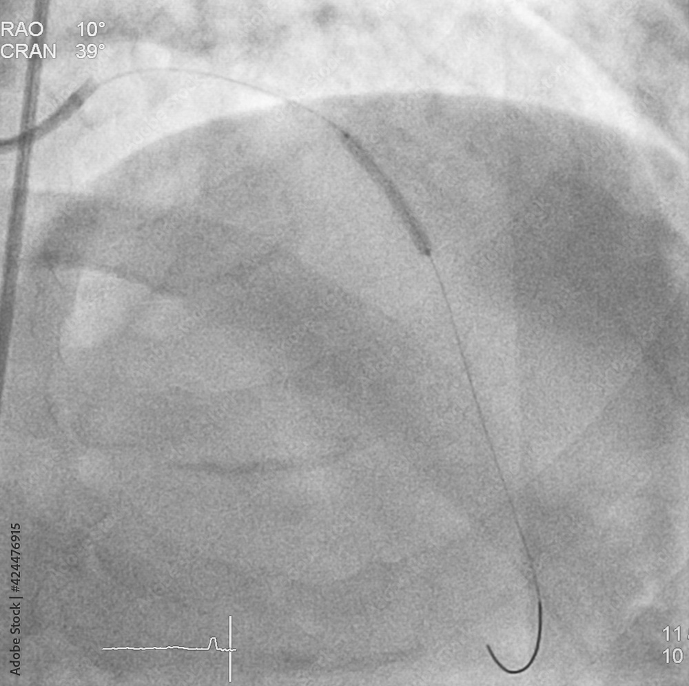 X ray image performed drug eluting stent (DES) deployment at mid left ...
