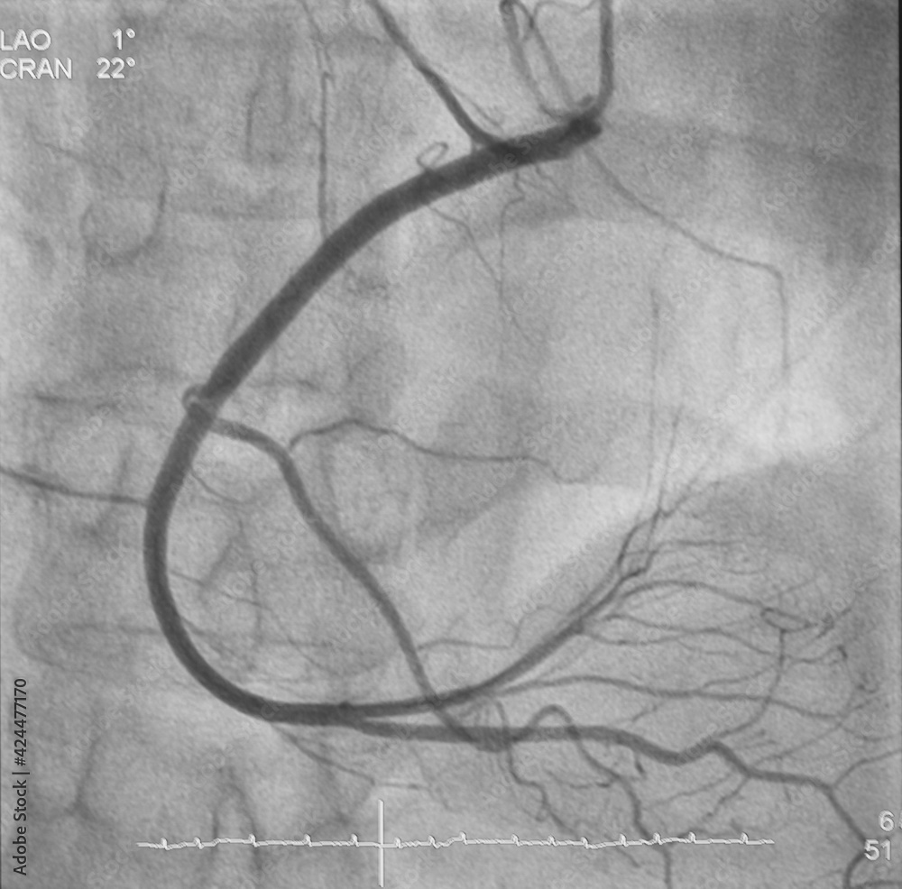 Coronary angiogram (CAG) was performed right coronary artery (RCA ...