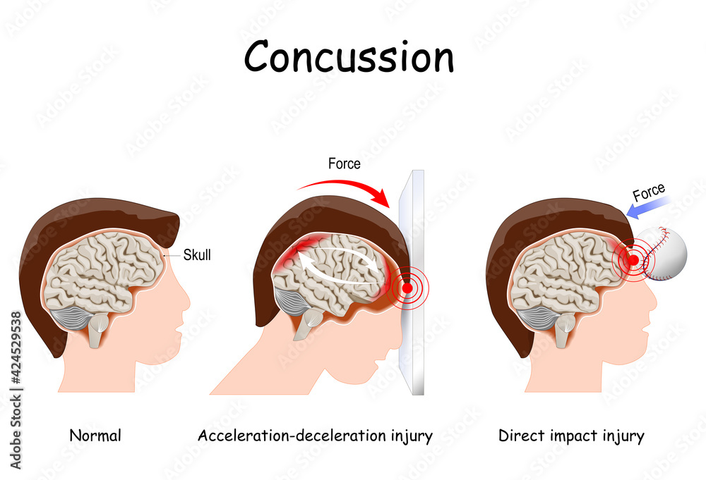 concussion in sport. mild traumatic brain injury เวกเตอร์สต็อก | Adobe ...