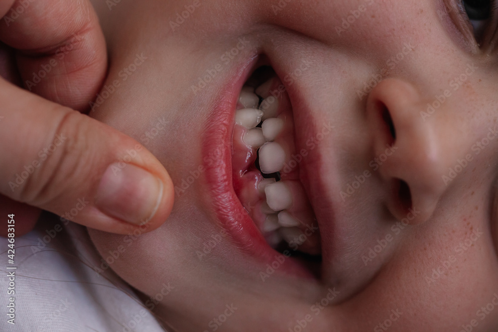 close-up the mother's hand pulling the daughter's lower lip down and ...