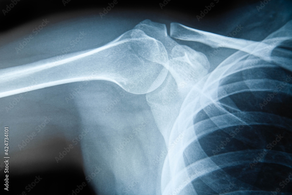 Radiografía del cuerpo humano, hombro. Stock Photo | Adobe Stock