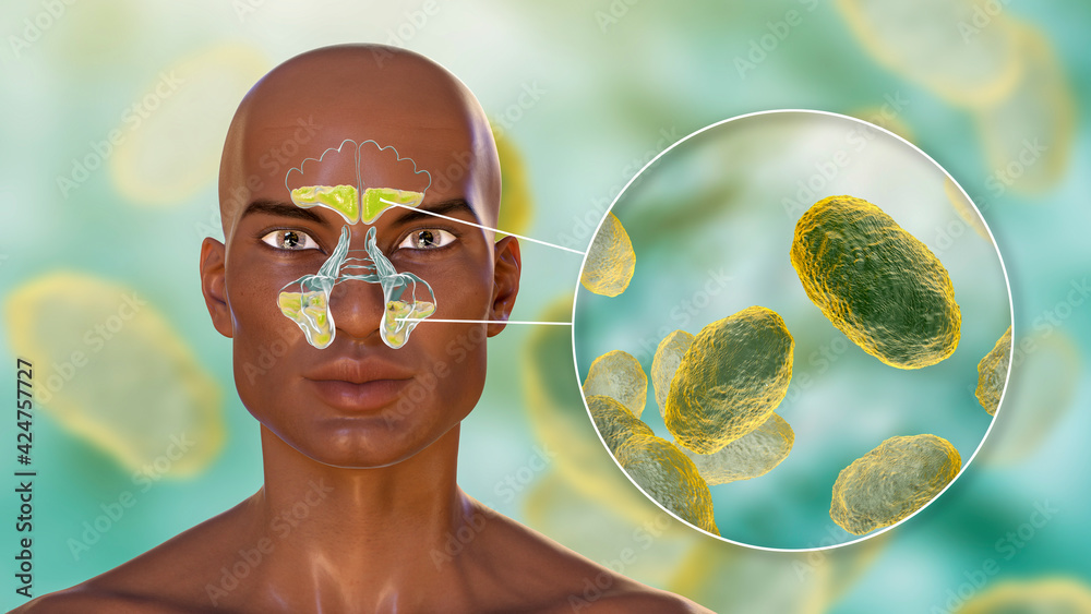 Haemophilus influenzae bacteria as a cause of sinusitis Stock ...