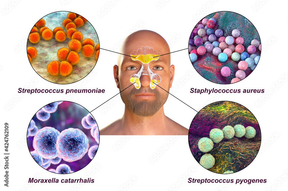 Purulent inflammation of frontal and maxillary sinuses in a man and ...