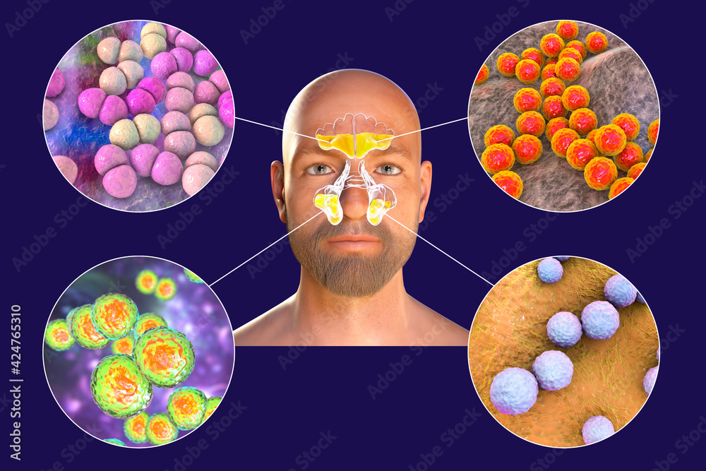 Purulent inflammation of frontal and maxillary sinuses in a man and ...