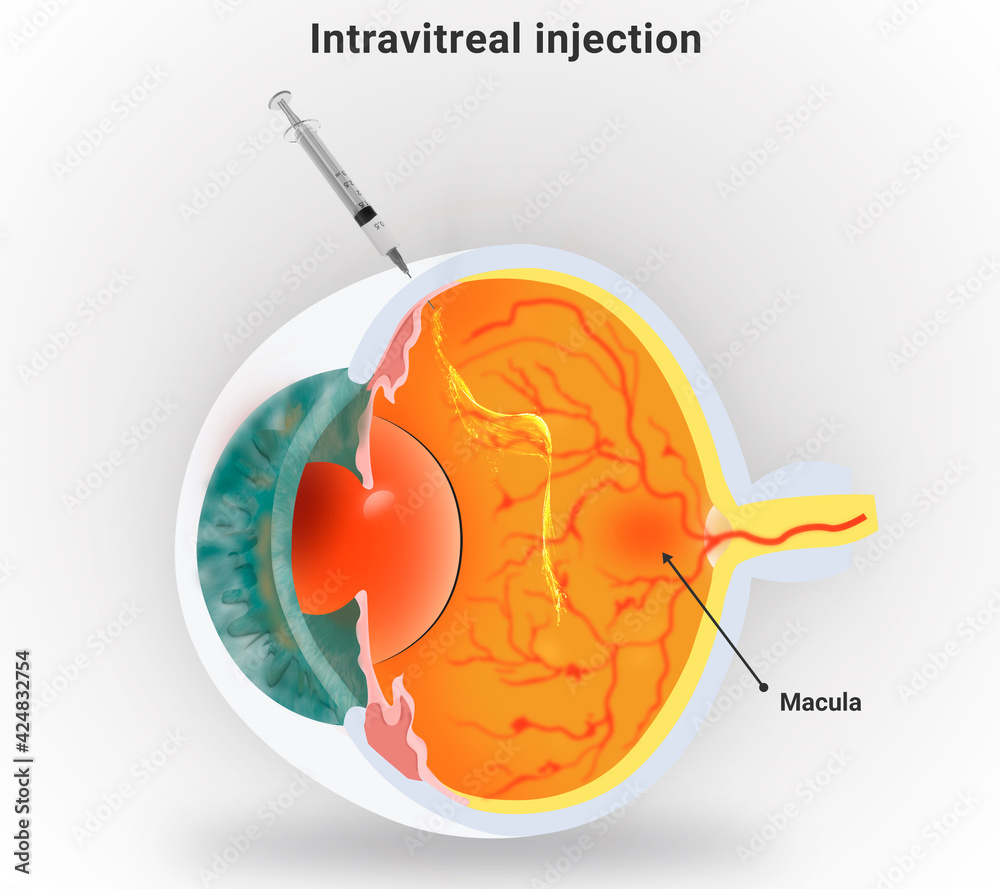 Intravitreal Injection Procedure for Macular Degeneration Stock ...