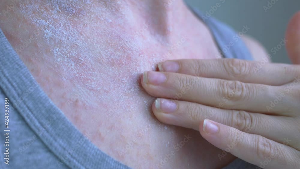 On the upper part of the womans chest, a reddened rash. White ointment ...