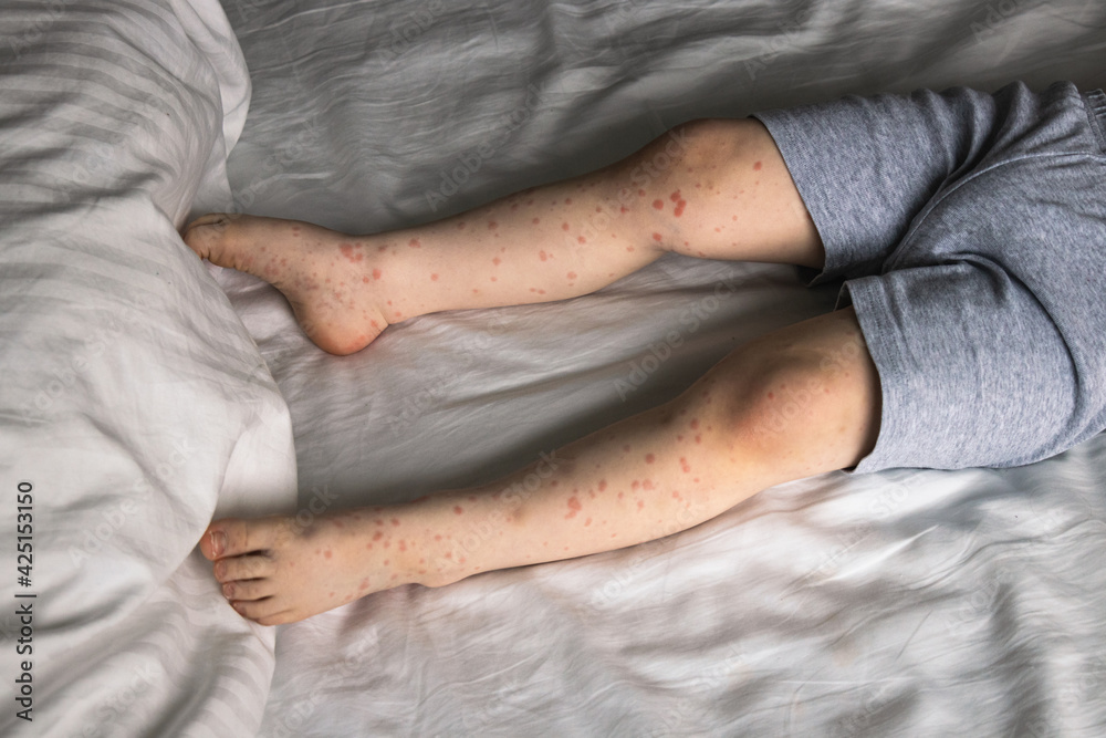 A toddler boy with rash infected by Roseola Disease. Roseola is a ...
